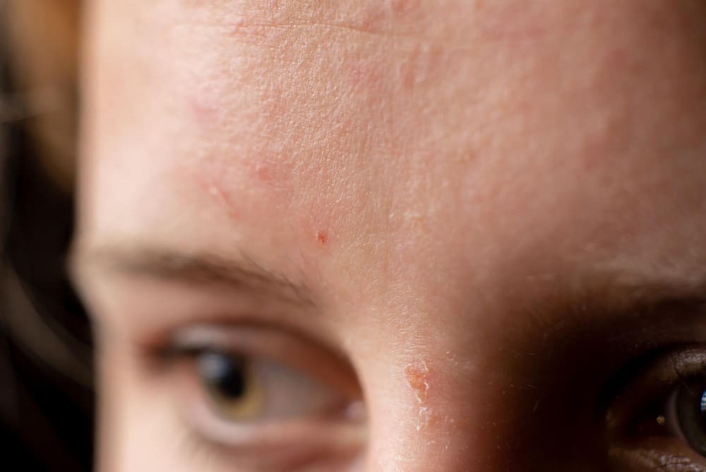 Pimple Between Eyebrow Spiritual Meaning 9 Warnings pimple-between-eyebrow-spiritual-meaning-9-warnings